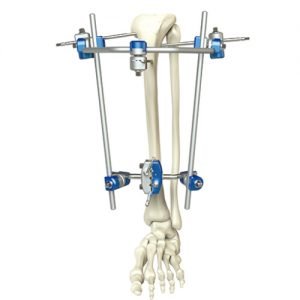 External Fixator Products - Orthopedic Drills