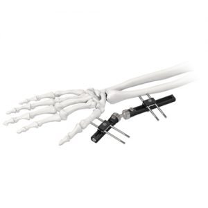 Forearm External Fixator - Orthopedic Drills