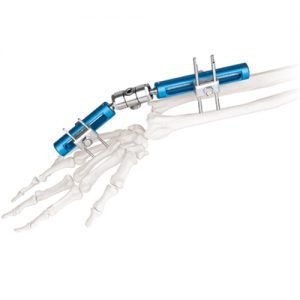 Forearm External Fixator - Orthopedic Drills